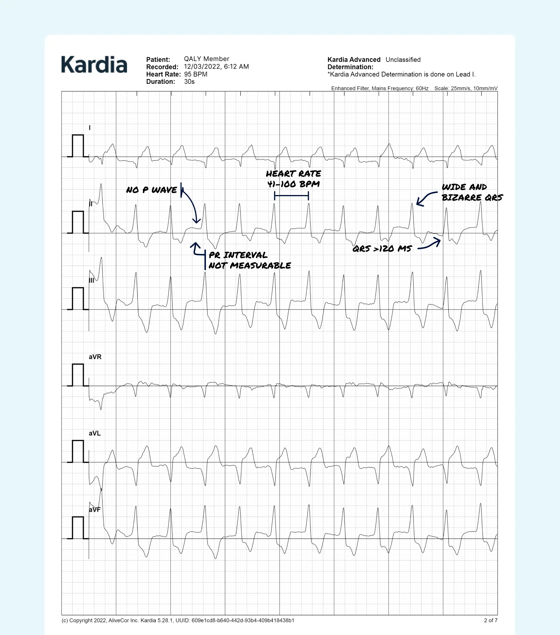 Sinus Rhythm Vs. Accelerated Idioventricular Rhythm on Your Watch ECG | Qaly